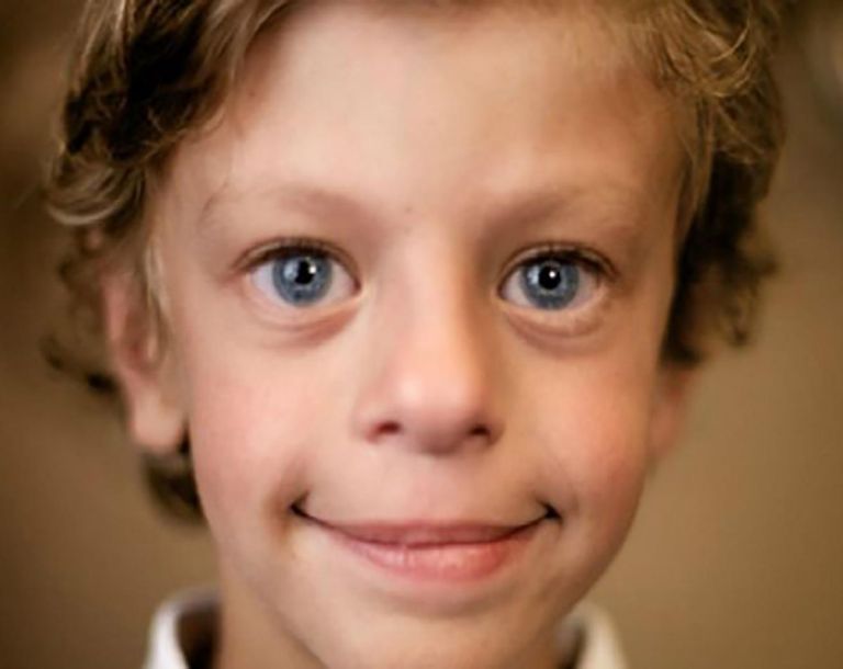 Síndrome de Williams, el trastorno genético que hace a los niños ...