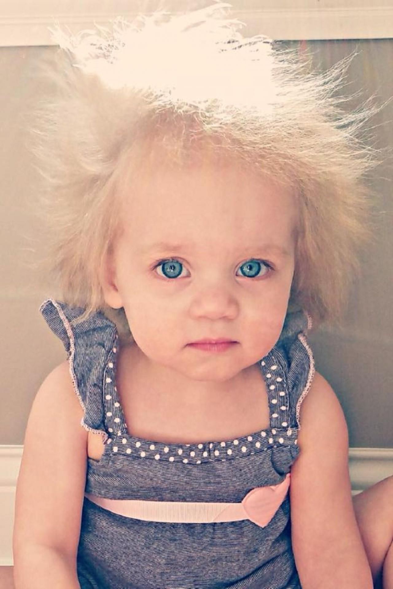 La Bebé Que Tiene El Síndrome Del Cabello Impeinable Y Es Furor En Las